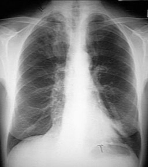 CXR self evaluation exercise 4
