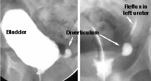 Bladder Diverticulum Cystoscopy