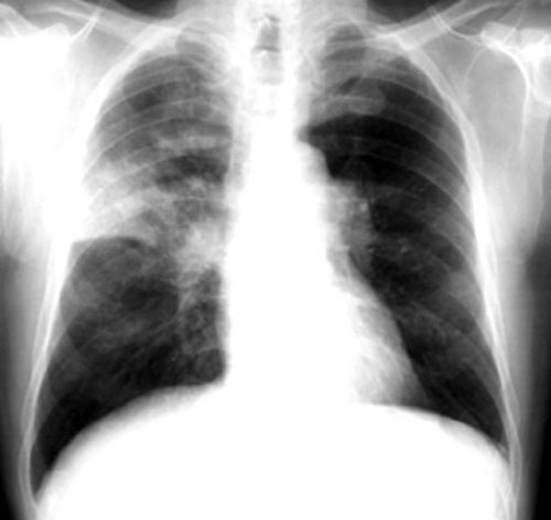 CXR self evaluation exercise 3