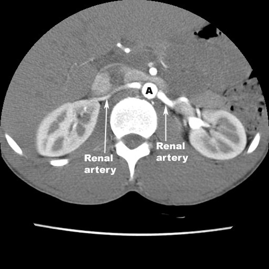 Identify The Renal Artery Aorta And Vena Cava In This Ct Click The