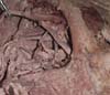 Posterior Triangle and Axilla Dissection