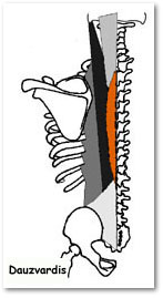 Erector Spinae-Spinalis