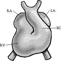 Dextrocardia