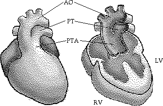 Persistent Truncus Arteriosus