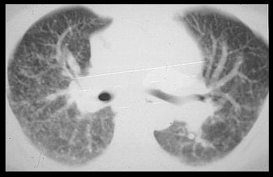 Image of Sarcoidosis - Lung Parenchymal Disease
