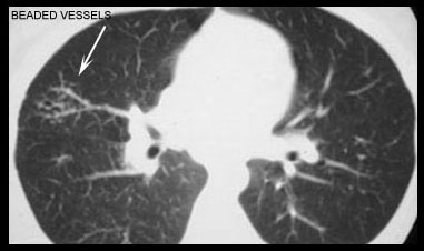 Image of Sarcoidosis - Lung Parenchymal Disease