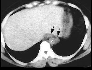 Image of Sarcoidosis - Lymphadenopathy