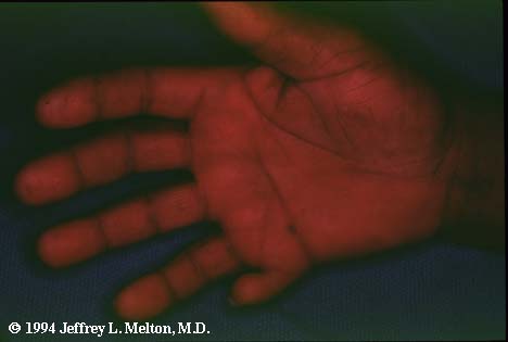 Supernumerary digit (1)