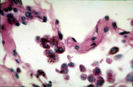 All of the following are GMS and PAS positive