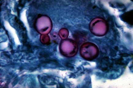 Blastomycosis lung-budding