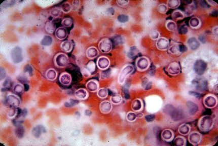 Cryptococcus lung