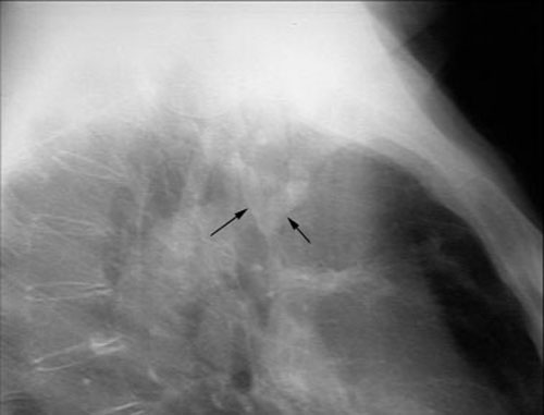 K:\lumen\MedEd\MEDICINE\PULMONAR\cxrself\q34.htm