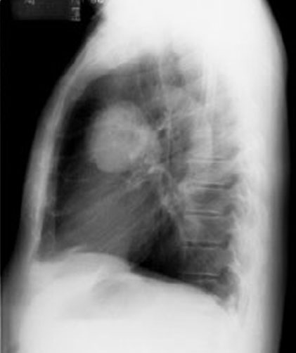 K:\lumen\MedEd\MEDICINE\PULMONAR\cxrself\q34.htm