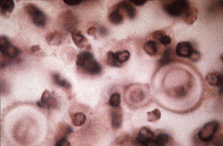 All of the following are GMS and PAS positive