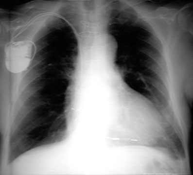 Note thelargesubcarinal mass in a patient with previously resected left ...