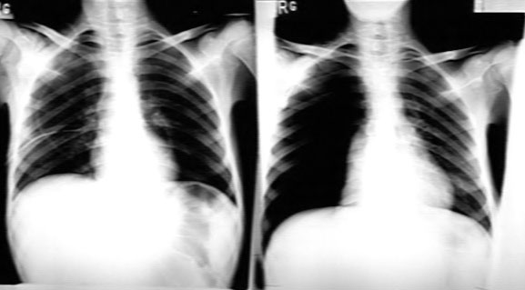Note the enlarged hemithorax in the CXR on right withpneumothorax. The ...