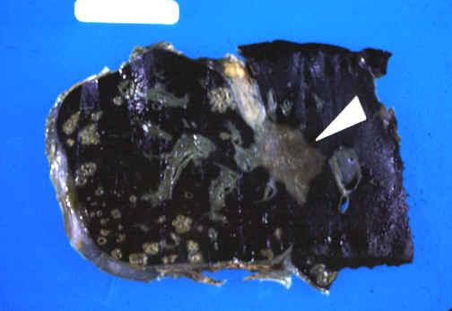 Pathology Outlines - Primary sclerosing cholangitis