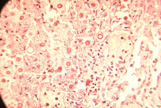 Parasitic Infestations