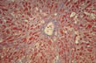 Liver Fibrosis