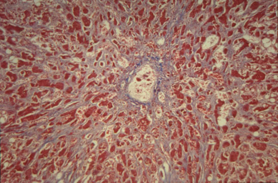Liver Fibrosis