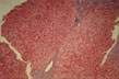 Liver Fibrosis