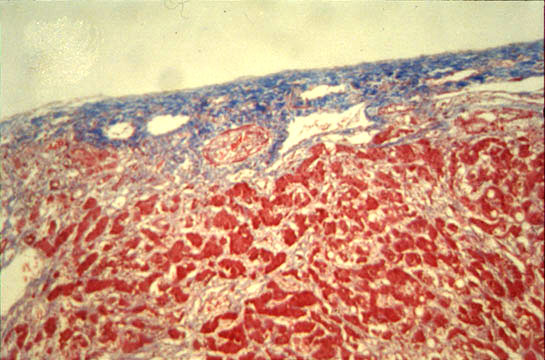 Liver Fibrosis