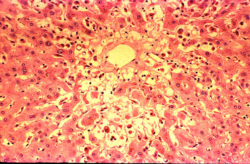 Spotty necrosis may be seen in