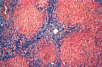 infectious cholangits