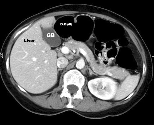 Course of Esophagus