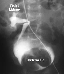 Ureterocele Ivp