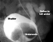 Ureterocele Ivp