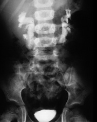 Horseshoe Kidney