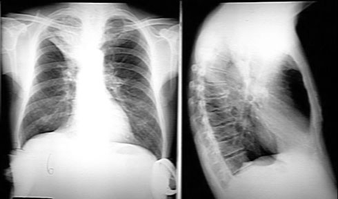 Right upper lobe atelectasis