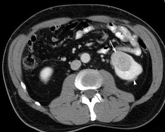 Renal Cancer