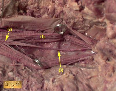 Cord 2 Dissection