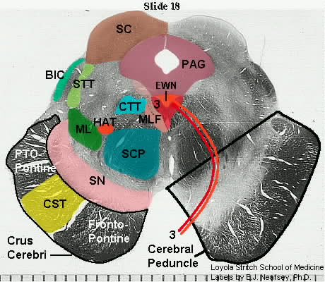 Cerebral Peduncles
