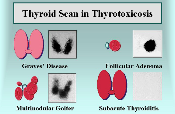 Multinodular Thyroid