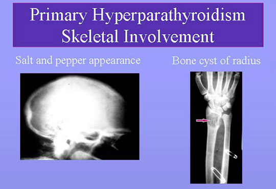 Primary Hyperparathyroidism Radiology