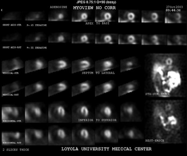 Images of Myocardial Infarction
