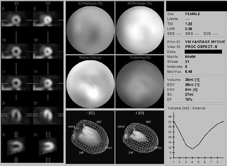 Images of Myocardial Infarction