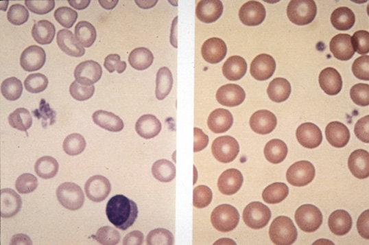 Images of Anemia
