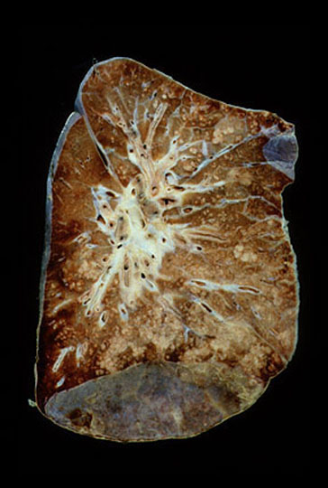 Lung patchy infiltrate - OliverEdward1's blog