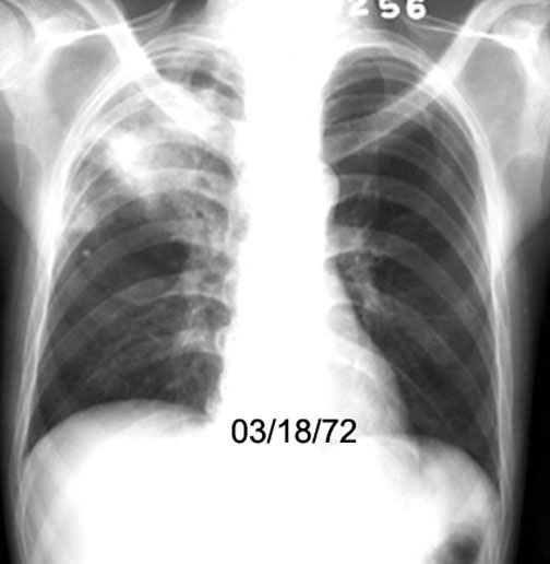 Cavity in Chest x-ray / Radiology