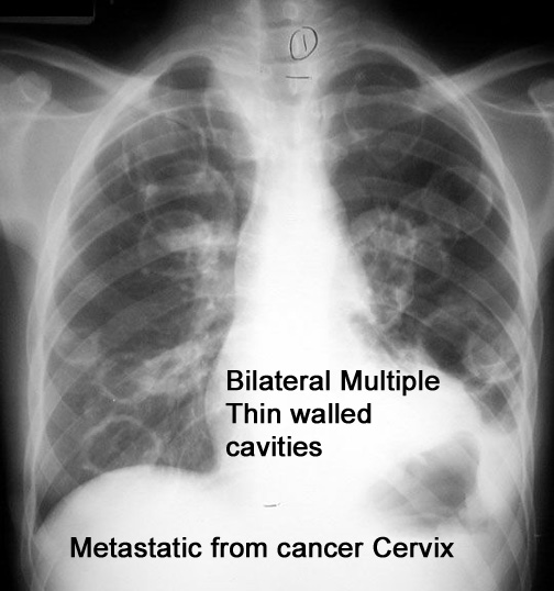 Cavity in Chest x-ray / Radiology
