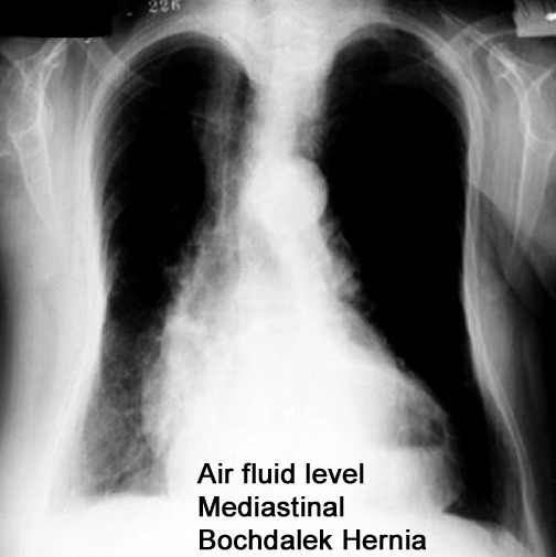 Cavity in Chest x-ray / Radiology