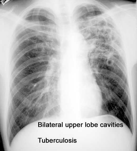 Cavity in Chest x-ray / Radiology