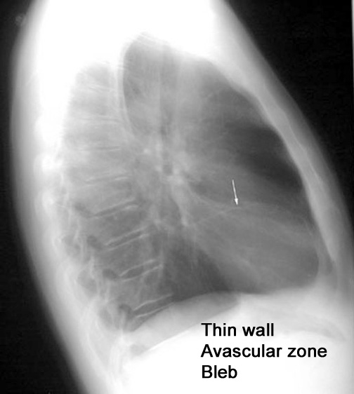 Cavity in Chest x-ray / Radiology