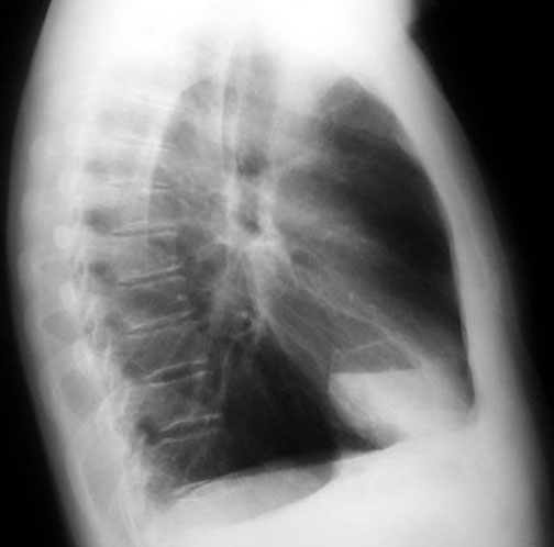 Cavity in Chest x-ray / Radiology