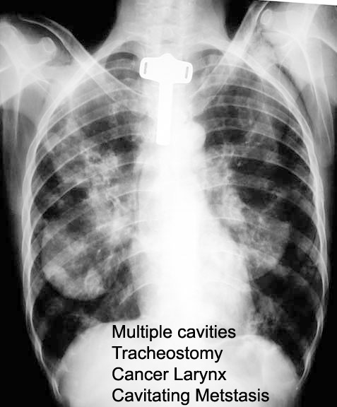 Cavity in Chest x-ray / Radiology