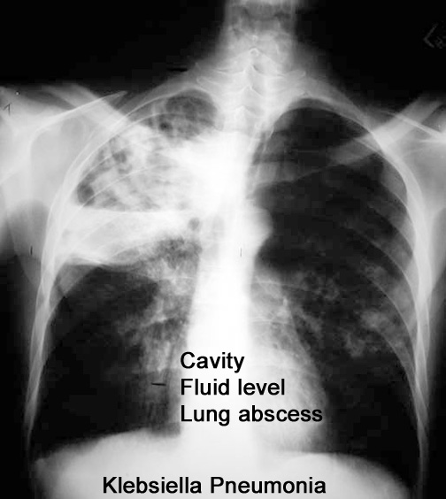 Cavity in Chest x-ray / Radiology